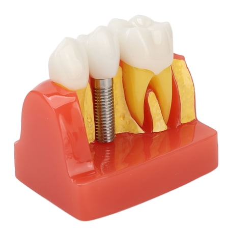 Educational Tooth Model,Dental Implant Model Removable Dental Implant ...