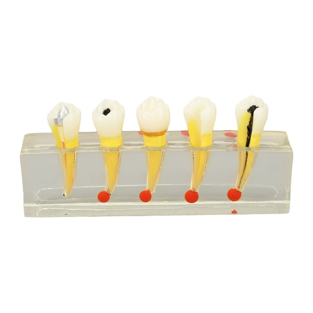 Dental Caries Developing Model,Teeth Model Dental Study Dental Caries ...