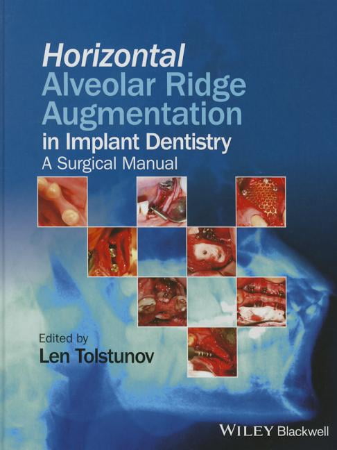 Horizontal Alveolar Ridge Augmentation in Implant Dentistry : A ...