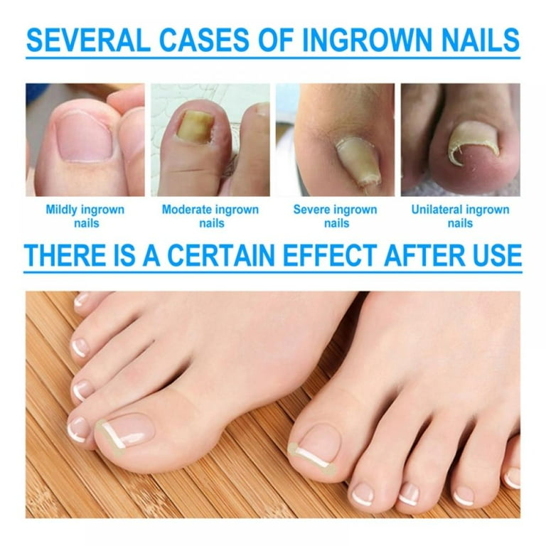 Ingrown Toenail Treatment Cotton
