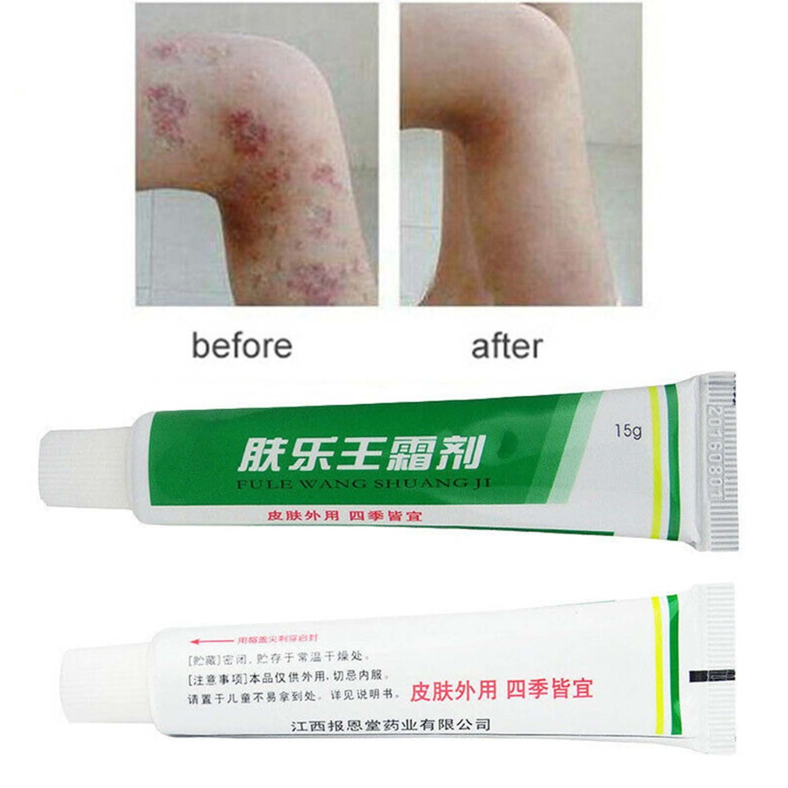 Ungüento para psoriasis, dermatitis y eczema de la piel | Bodega ...
