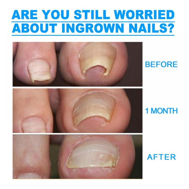 Ingrown Toenail Treatment Cotton