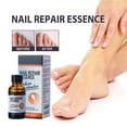GARENAS Nail Care Solution for Onychomycosis Damaged Discolored Brittle Nails Thickening and ...