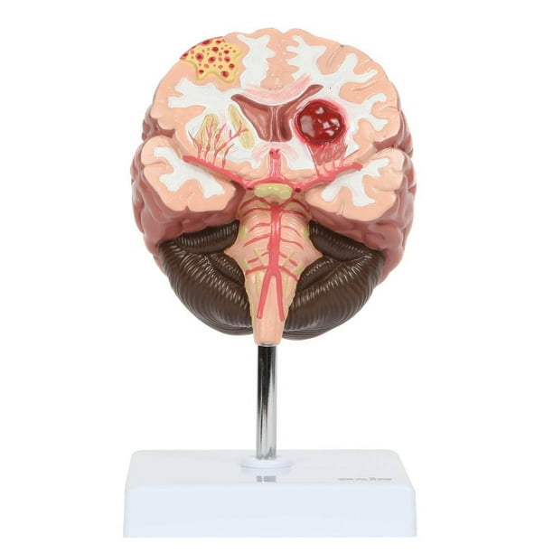 Axis Scientific Human Brain Anatomy Model with Pathologies - Walmart.com
