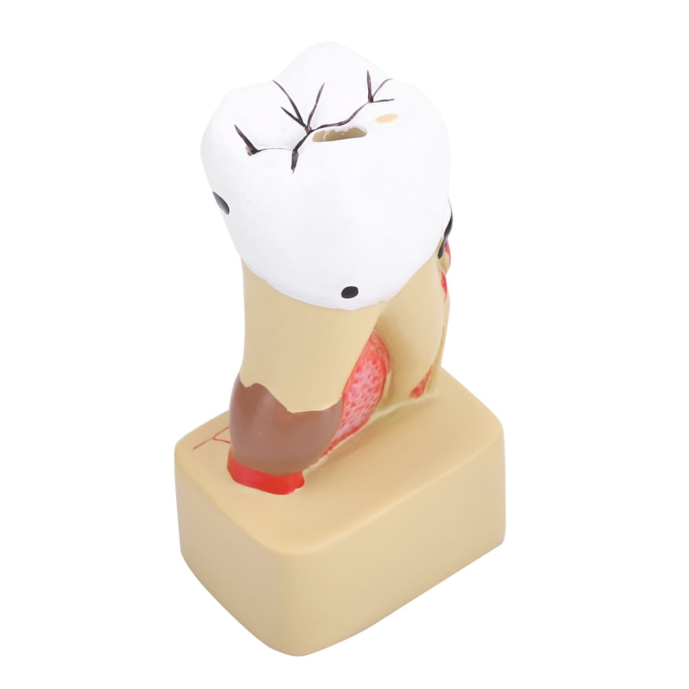 modelo de diente didáctico para estudio integral de patologías dentales ...
