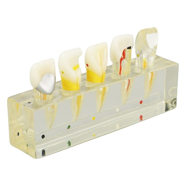 Endodontic Teeth Model,Dental Pulp Cavity Model Dental Endodontic Model ...