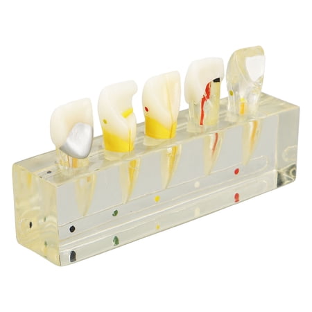 Endodontic Teeth Model,Dental Pulp Cavity Model Dental Endodontic Model ...