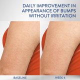 Cetaphil Rough & Bumpy Skin Daily Smoothing Moisturizer, 10 oz ...