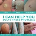 Yoomi Wart Removal for Common Warts on Hands, Elbows, & Knees or ...