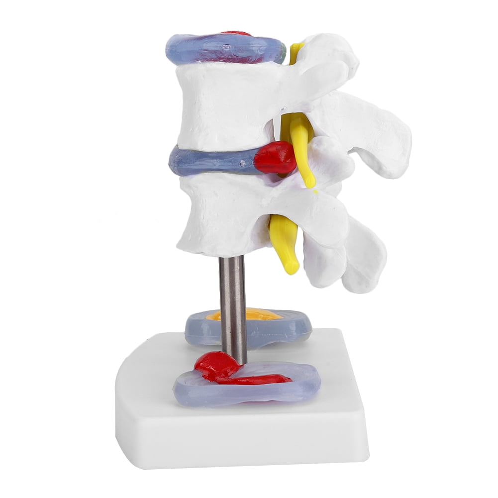 Domqga Spine Model,Anatomical Lumbar Disc Herniation Demonstration ...