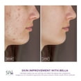 Spa Sciences Bella Wet/Dry Diamond Microdermabrasion & Pore Extraction ...