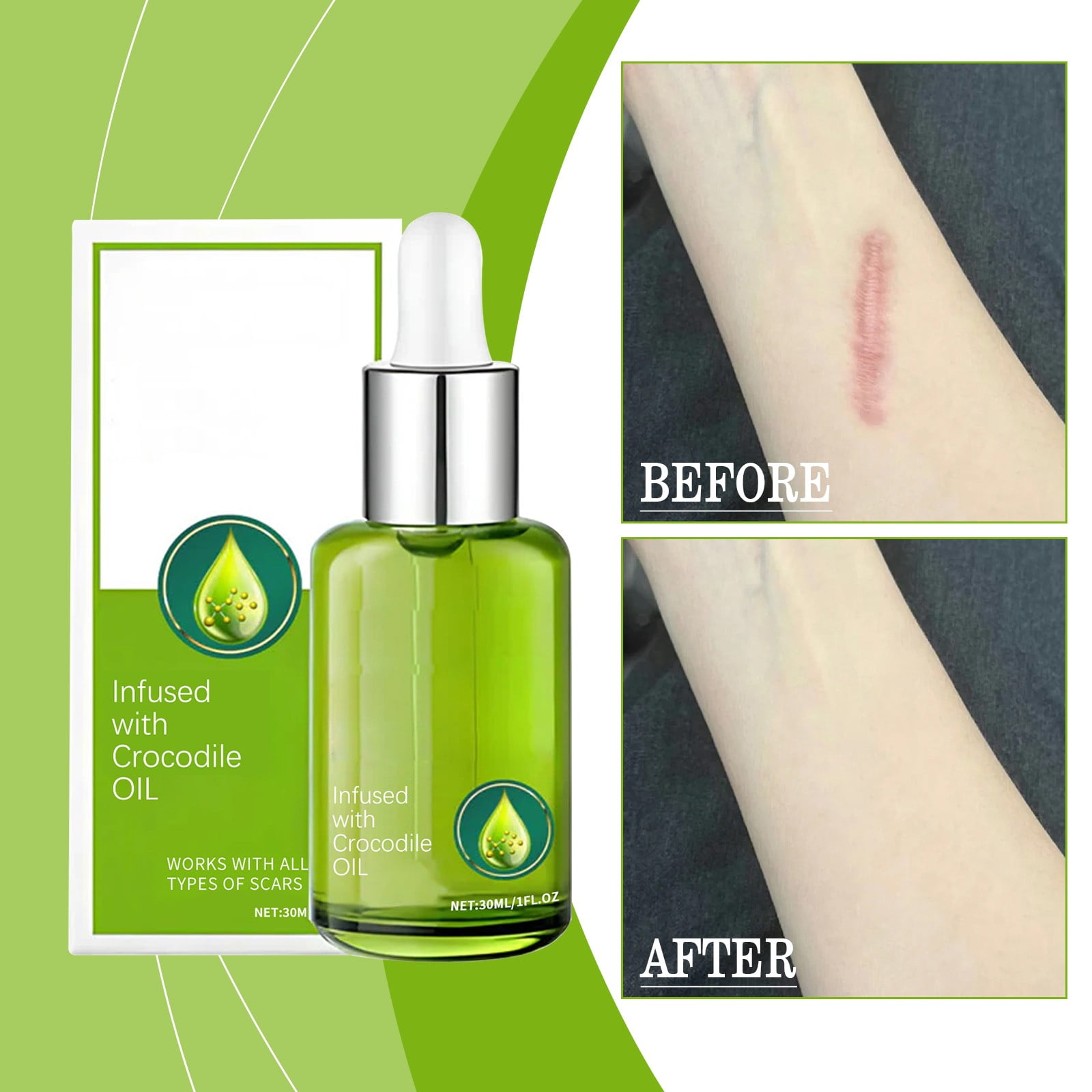 Scar Fluid Scar Mild Moisture Desalination Stretch Marks Desalination ...
