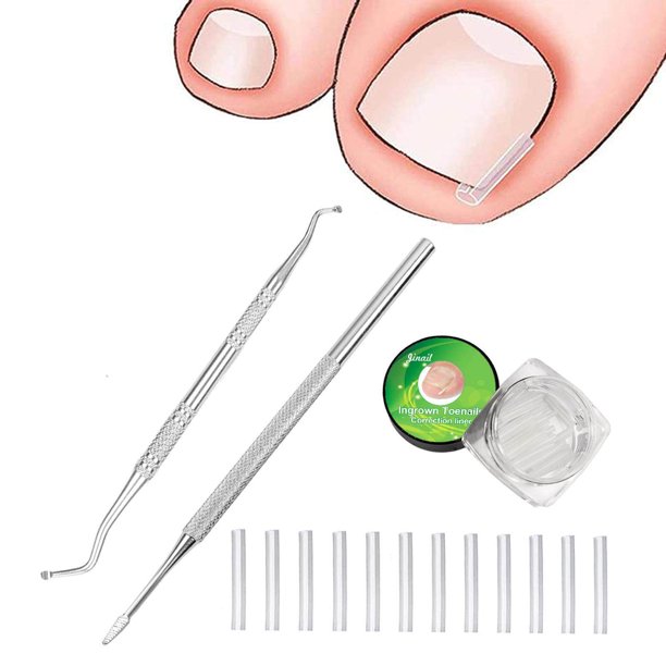 fastboy 50 Pieces Ingrown Toenail Corrector Strips Nail Groove Pad ...