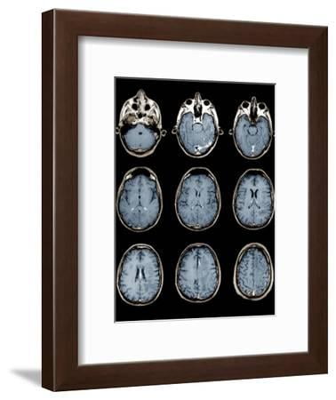 Normal Brain, MRI Scans, Framed Art Print Wall Art by ZEPHYR - Walmart.com