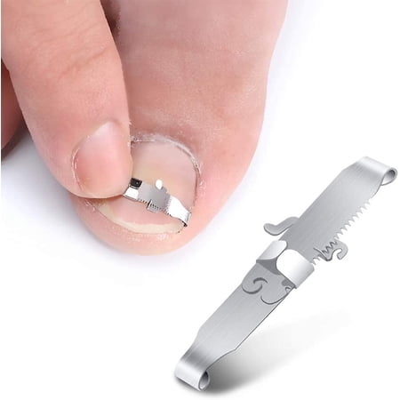 2pcs Ingrown Toe Correction Tools, Toe Correction Buckle And Toe Lifter ...