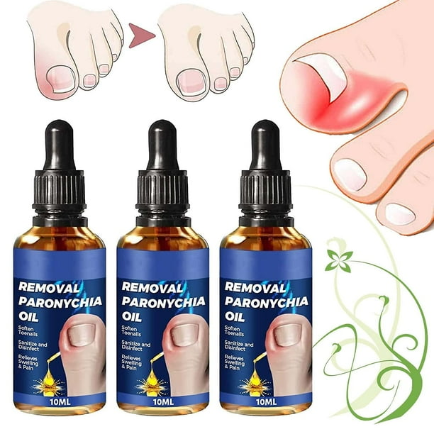 Toe Nail Care Removal Paronychia Oil,anti Paronychia Relief Oil,toenail ...
