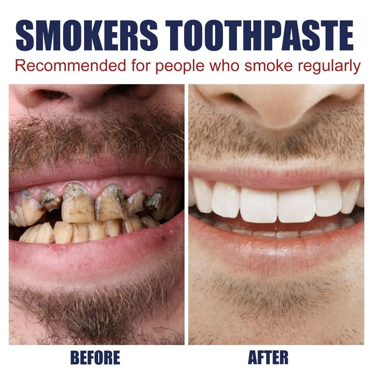 Teeth After Smoking