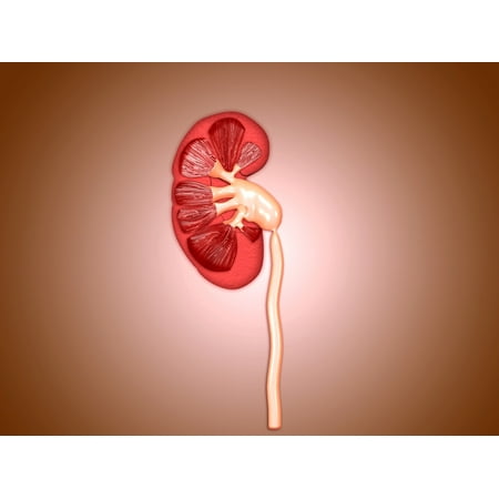 Ureteropelvic junction (UPJ) obstruction in the kidney. UPJ is defined ...