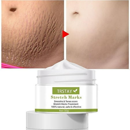 Pregnancy Repair Cream Stretch Mark Removal Removal Acne Scar Stretch ...