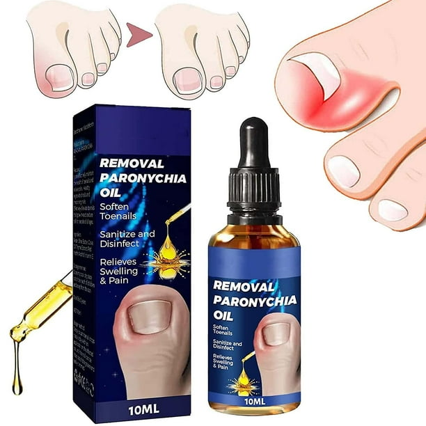 Toe Nail Care Removal Paronychia Oil,anti Paronychia Relief Oil,toenail ...