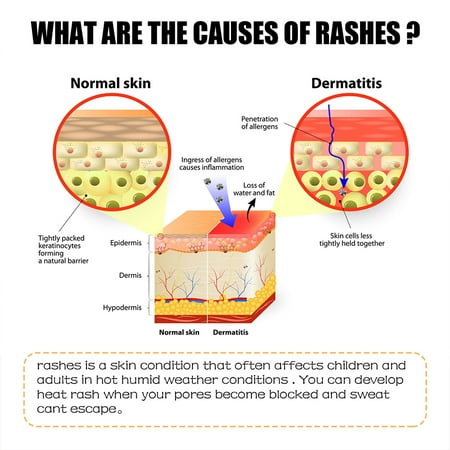 140g Adults Prickly Heat Powder Hot Weather Hot Weather Accessory Body ...