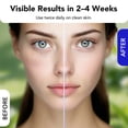 DERMFREE, Milia Spot Treatment, 30 mL, Fragrance-Free, Suitable for ...