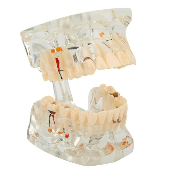 Dental Teeth Models,Transparent Disease Teeth Model Teeth Models Teeth ...