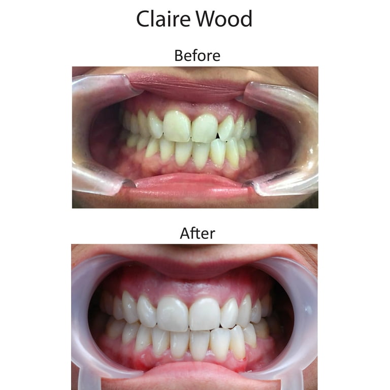 Clear Retainer With False Teeth