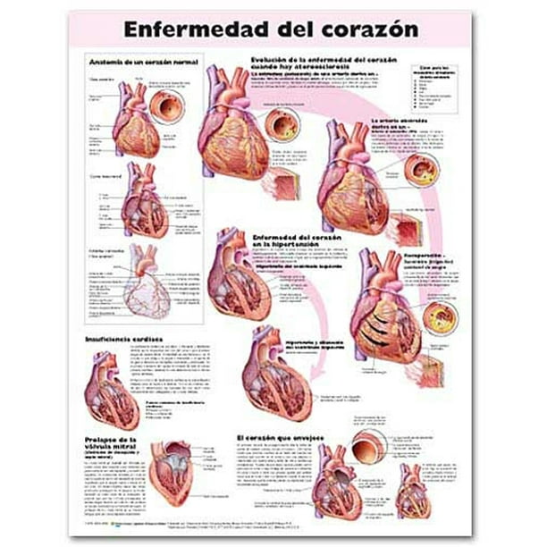 Heart Disease Anatomical Chart in Spanish (Enfermedad del corazón ...