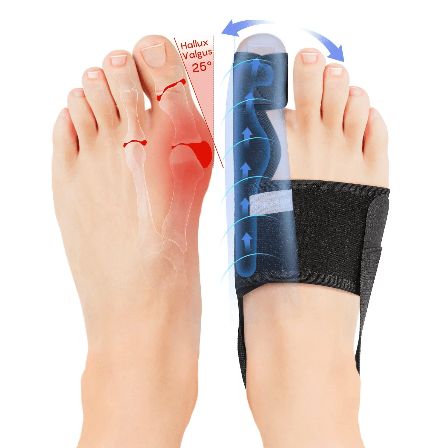 Kunstm Bunion Corrector for Women and Men, Premium Orthopedic Big Toe ...