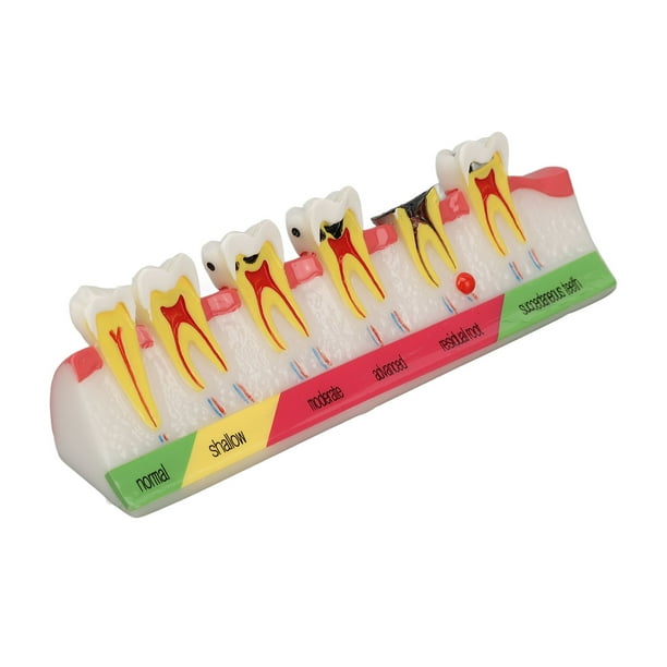 Dental Disease Model,Dental Caries Model 6 Resin Dental Caries Model ... Dental Disease Model,Dental Caries Model 6 Resin Dental Caries Model ...
