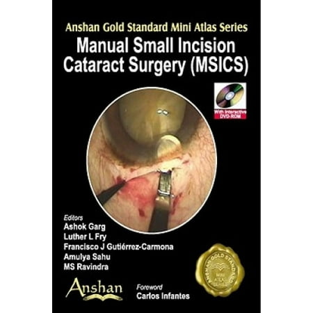 Mini Atlas of Manual Small Incision Cataract Surgery (Anshan Gold ...