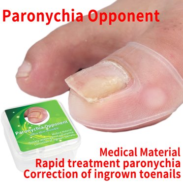 Ingrown Toenail Pain Reliever, 1 kit, (w/ Gel, 12 retainer rings & 12 ...