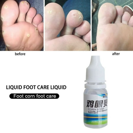 10ml Powerful Foot Corn Remover Foot Callus Remover Liquid Foot Care ...
