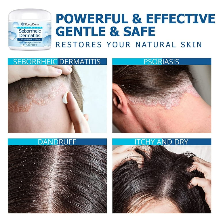 Seborrheic Dermatitis: On Scalp, Treatment, Crib Cap, And, 50% OFF Seborrheic Dermatitis: On Scalp, Treatment, Crib Cap, And, 50% OFF