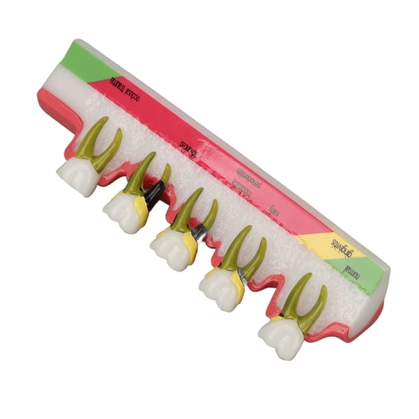 Periodontal Disease Display Model,Teeth Periodontal Disease Model ...