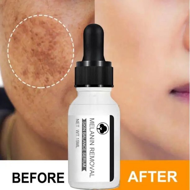 Suero antienvejecimiento para eliminar manchas oscuras, crema blanqueadora de pecas, aclara la ...