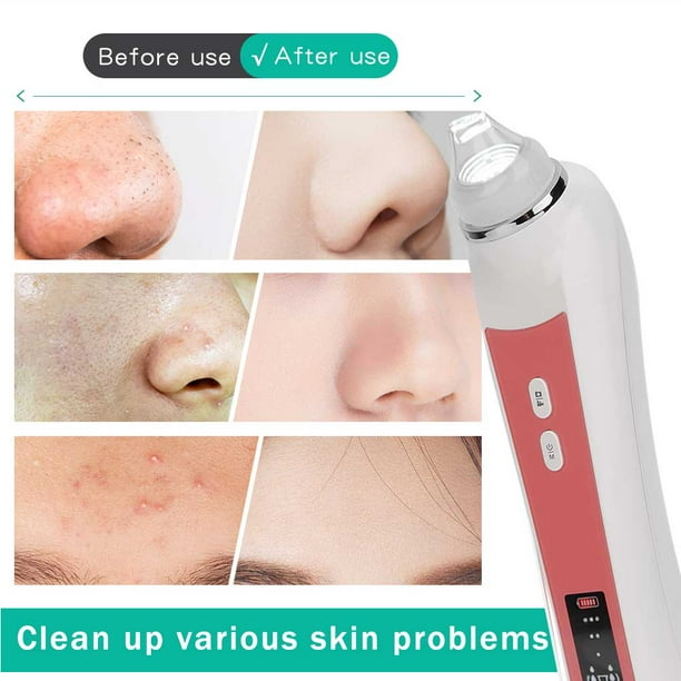 Facial Cleaning Machine Blackhead Suction Blackhead Removal Machine ...