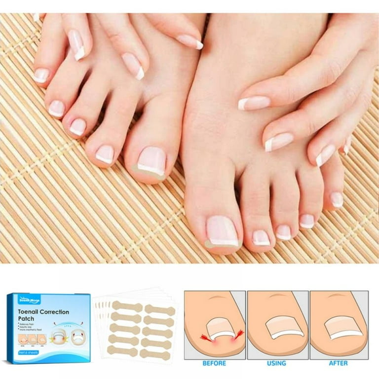 Ingrown Toenail Treatment Cotton