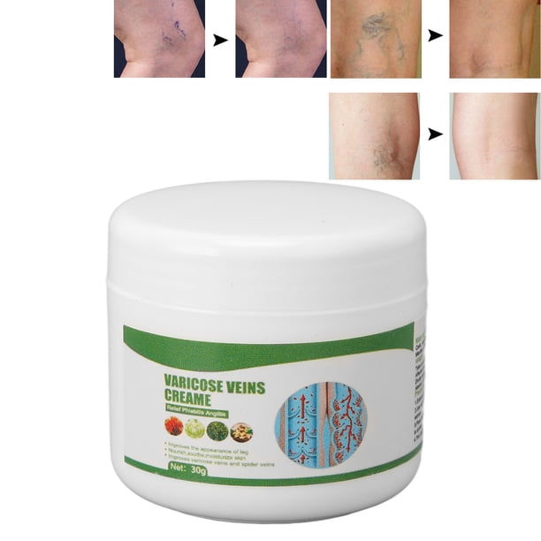 30g Varicose Veins Repair Cream, Leg Pain Soothing, Leg Care Massage ...