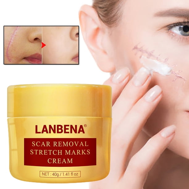 Archer 40g Scar Removal Cream Soften Skin Acnes Fade Stretch Marks ...