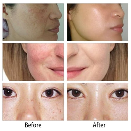 LHCER Handheald Red Light Picosecond Laser Pen Scar Tattoo Removal ...