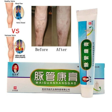 Bilges Itching Lumps Vasculitis Cream Medical Varicose Veins Treatment ...