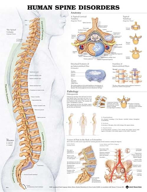Human Spine Disorders Anatomical Chart - Walmart.com