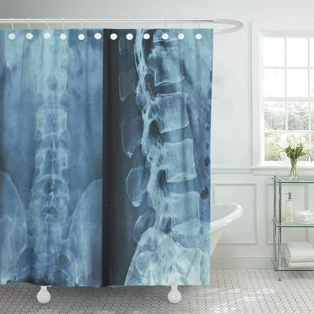 PKNMT Blue Xray X Rays the Spine Surgery Human Radiography Lumbar Side ...
