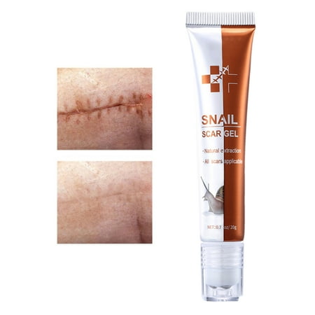20g Fading Scar Cream Lighten Burn Scars and Scar Cream Acne Scar Gel ...