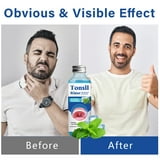 HWTong Tonsil Stone Mouthwash Oral Rinse Liquid for Bad Breath and Dry ...