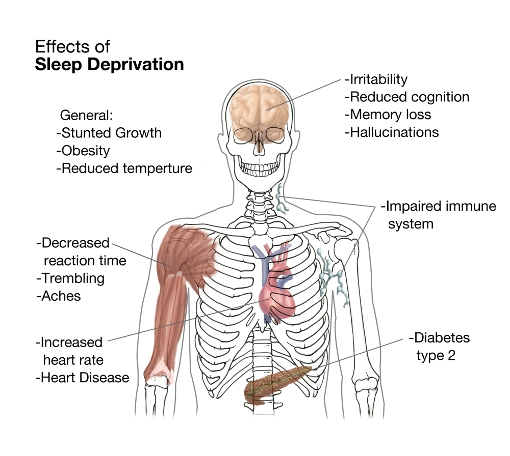 Sleep Deprivation Effects Illustration Poster Print By Spencer sleep-deprivation-effects-illustration-poster-print-by-spencer