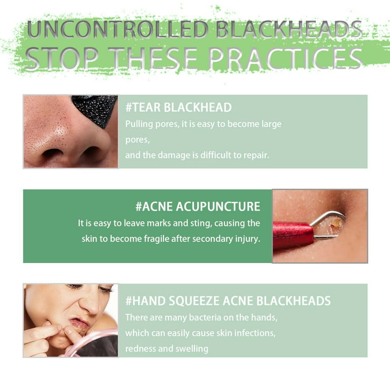 Blackhead Squeeze Acne Treatment And Blackhead Removal Adelaide