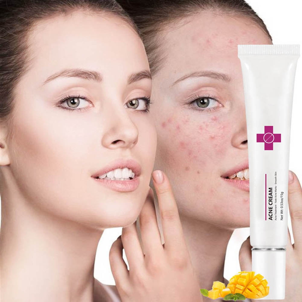 Acne Spot Cream Fast Acting Formula Cream for Clearing Severe Acne from ...